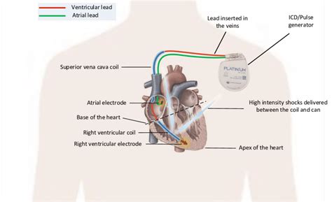 What Is A Dual Chamber Icd Aveir Single And Dual Chamber Leadless
