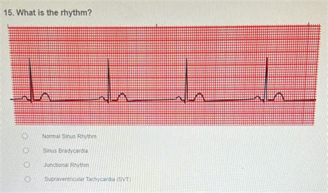 Solved 15 What Is The Rhythm Normal Sinus Rhythm Sinus Bradycardia