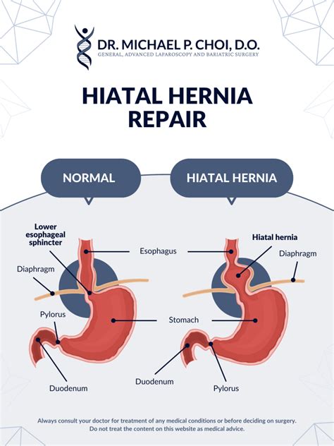 Hiatal Hernia Repair In South Florida