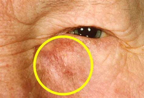 Eye Cancer Symptoms And Treatments The Grand Healthcare