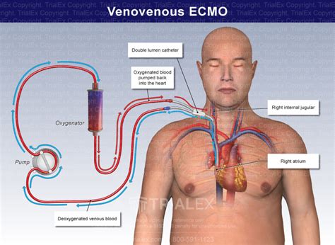 Venovenous Ecmo Trialquest Inc