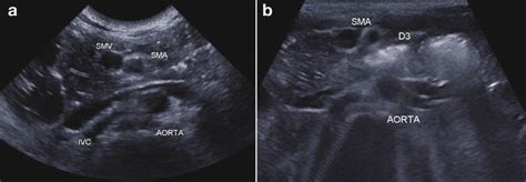 Normal Abdominal Ultrasound