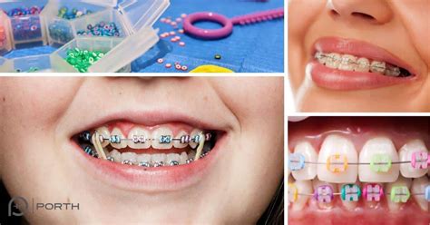 Braces Colors How To Pick The Right Color For Your Braces