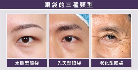 眼袋与泪沟差在哪边？常见眼袋手术做法一起看 佳思优整形医美诊所