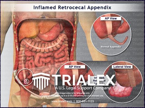 Inflamed Retrocecal Appendix