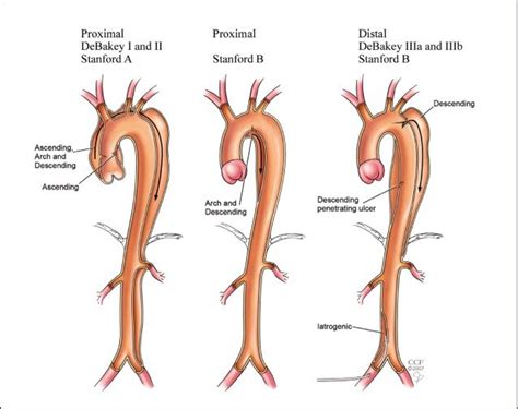 Dacron Graft Repair Of Ascending And Descending Aortic Dissection Download Scientific Diagram