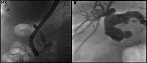 “when Two Scopes Meet”—use Of Double Cholangioscopy Allows F Liver Transplantation