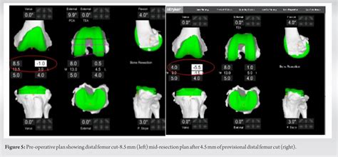 Mid Resection Workflow For Robotic Assisted Total Knee Arthroplasty In