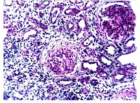 Diffuse Proliferative Glomerulonephritis Class Iv With Marked