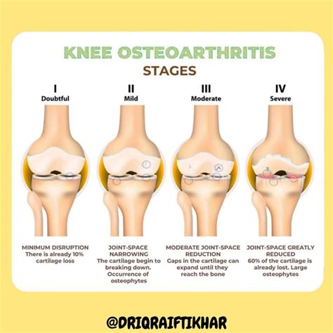 🦵 𝗦𝘁𝗮𝗴𝗲𝘀 𝗼𝗳 𝗞𝗻𝗲𝗲 𝗢𝘀𝘁𝗲𝗼𝗮𝗿𝘁𝗵𝗿𝗶𝘁𝗶𝘀 𝗞𝗻𝗲𝗲 𝗢𝗔 🦵 Dr Iqra Iftikhar