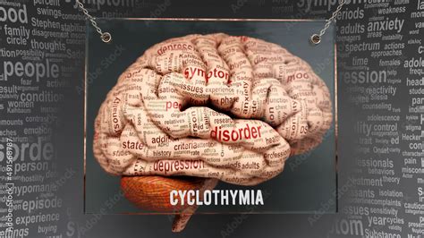 Cyclothymia Anatomy Its Causes And Effects Projected On A Human Brain Revealing Cyclothymia