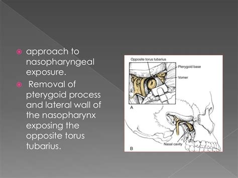 Infratemporal Fossa Approaches