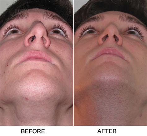 Nasal Septum Anatomy Function Nasal Septum Deviation And Hole