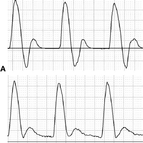 Tardus Parvus Low Resistive Monophasic Cw Doppler Waveform With