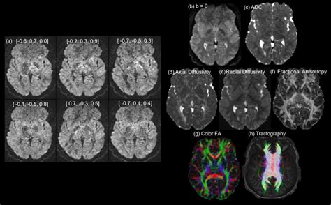 Diffusion MRI In A Healthy 17yearold Male To Derive Neural Tract Download Scientific Diagram