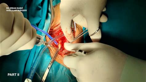 Carotid Endarterectomy Part Two Eversion Endarterectomy Dr Srdjan Babic