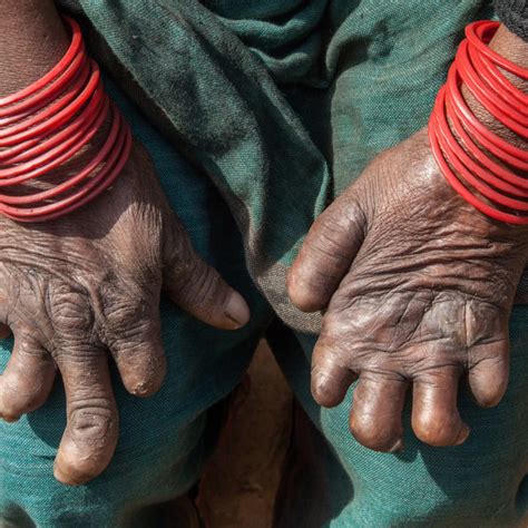 World Health Leaders Must Go The Last Mile To Eliminate Leprosy Stat