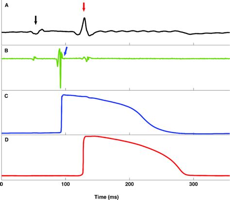 Example Of The Pseudo Ecg A Bipolar Electrogram B And
