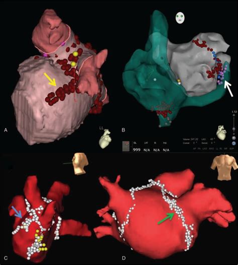 Alternative Strategies To Improve Success Rate Of Mitral Isthmus Block