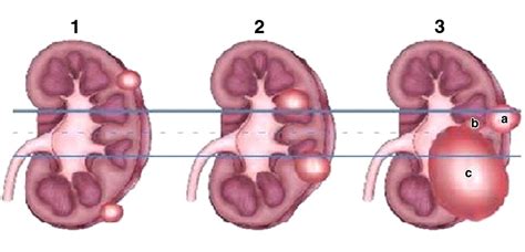 Renal Nephrometry Scoring System The Radiologists Perspective Ajr