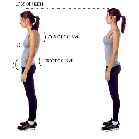 Kyphotic Posture