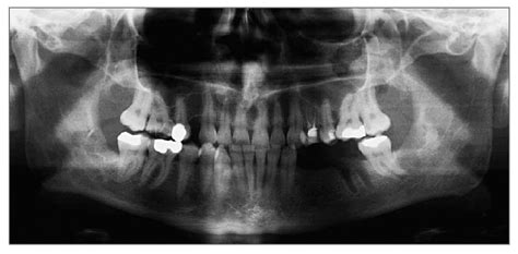 Osteomielitis De Mandíbula Tras Cirugía Del Tercer Molar Una