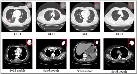 The Comparisons Of Visual Appearance Of Ggo Imaging Signs And Solid