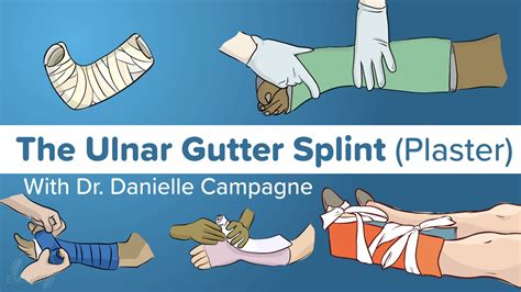 Ulnar Gutter Splint