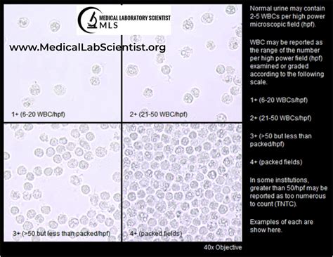 Microscopic Urinalysis Medical Laboratory Scientist Mls