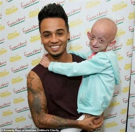 Photos Benjamin Button Disease Teenager With 144 Year Old Body Dies