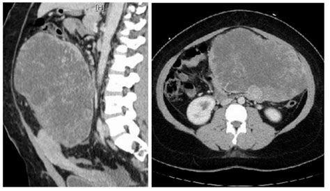Morphoproteomics Identifies The Ezh2 And Sirt1 Pathways As Potential Blocks To Differentiation