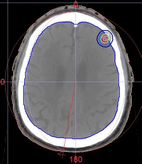 efficiency and benefits of linac based sbrt srs program