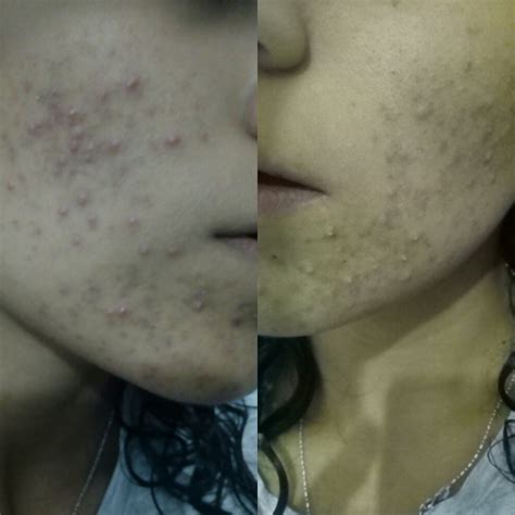 Hey Guys You Think This Is Hormonal Acne I Ve Been Taking Minocycline And I Don T Think It S