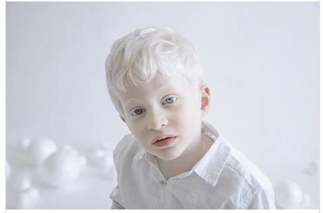 백반증과 백색증 차이 유머움짤이슈 에펨코리아