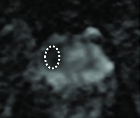 Adc Value Measurement A Representative Case Of A 71 Year Old Man With Download Scientific