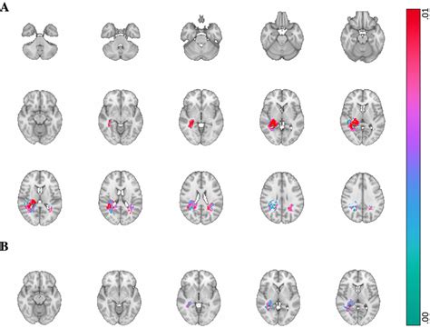 voxel wise p map for predictions of processing speed and cognitive