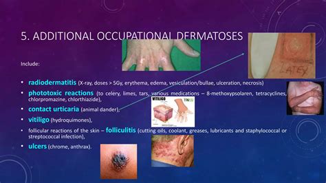 Occupationaldermatosesppt
