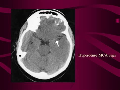 Stroke Subarachnoid Hemorrhage And Hypothermia For Cardiac Arrest