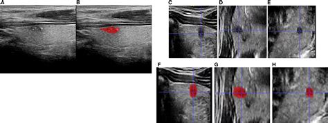 Frontiers Three Dimensional Ultrasound Based Radiomics Nomogram For
