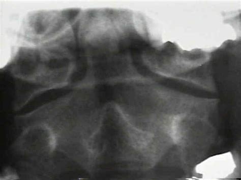 Odontoid View Wheeless Textbook Of Orthopaedics