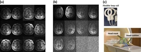 Deep Learning Based Acceleration Of Mri For Radiotherapy Planning Of