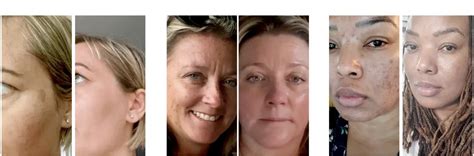 The Best At Home Chemical Peels For Hyperpigmentation