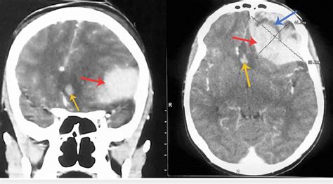 Patients Head Ct Scan Showing Left Frontal Epidural Bleed Red Arrow