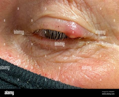 Stye On A Patients Eyelid A Stye Or Hordeolum Is A Bacterial