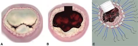Figure E2 Surgical Procedures For Entire Mitral Annular Calcification