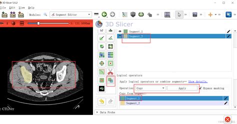 3d Slicer的学习（二） 图像的分割3dslicer窗宽窗位 Csdn博客