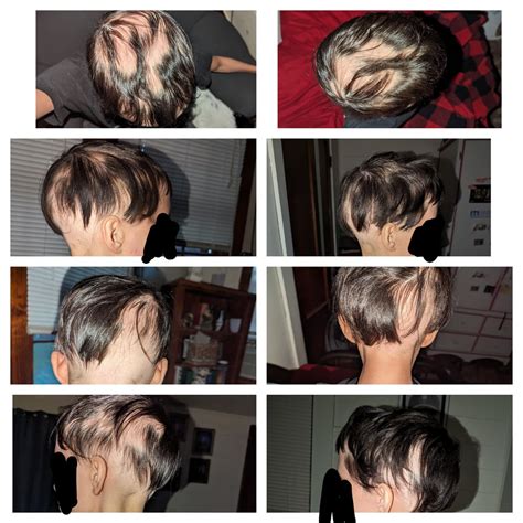 2 Months On Olumiant Ralopeciaareata