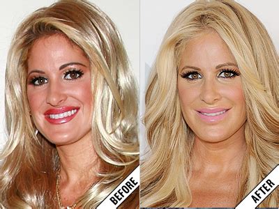 Botched Kelsey Before And After Kelseyvlogs