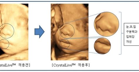 삼성 차세대 초음파 영상처리엔진 개발 태아 얼굴 보다 선명하게