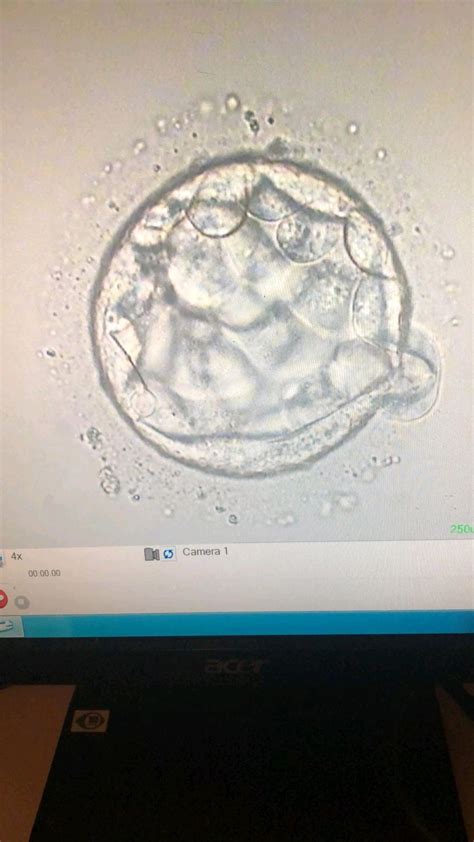 Blastocyst Hatching Vitrolife Irbid Specialty Hospital مستشفى اربد